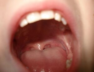Tonsilolitos todo lo que debes saber | Clínica Dental Gaudí